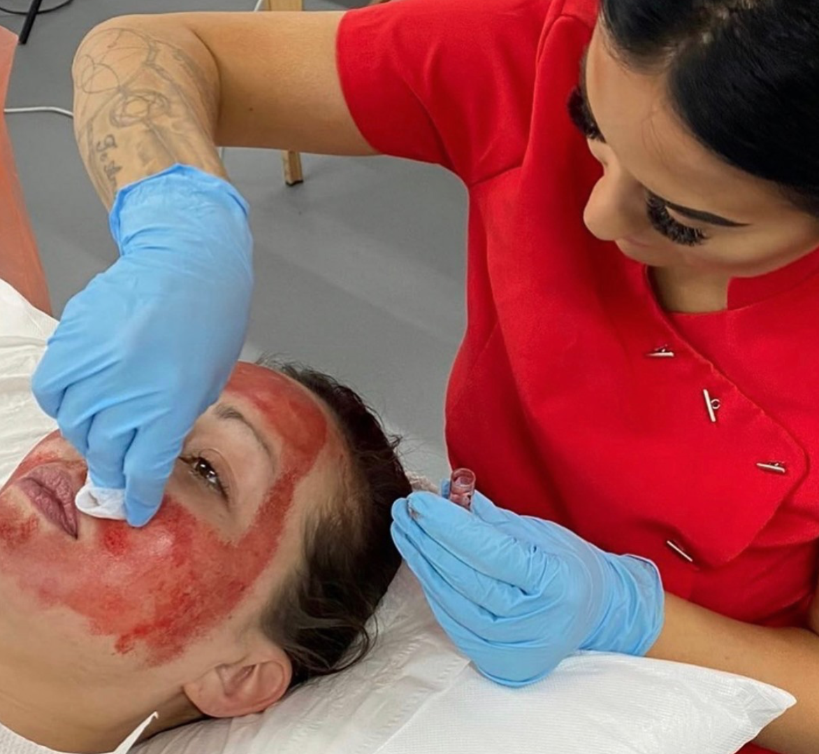 PRP Treatment for Face | Vampire Facial Near Me | PRP Procedure